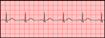Section Of A Normal Ecg, Lead Ii