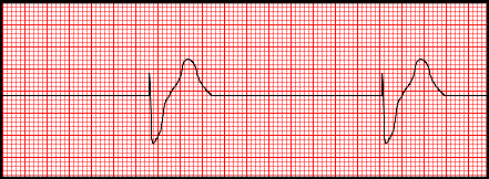 Section 9 : Ventricular Rhythm